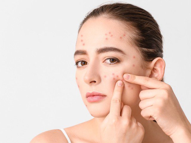 Can Medical Spa Treatments Help Treat Acne? - Creative Image